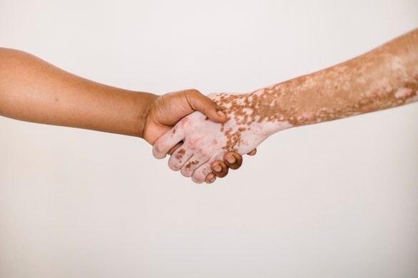 ¿Qué es un uñero? - Farmaceuticonline