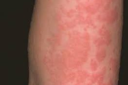 Erupción acneïforme, ¿cómo debemos tratarla? - Farmaceuticonline